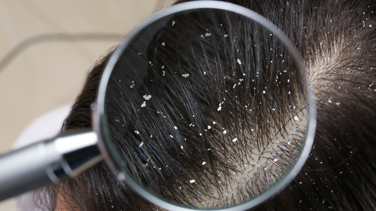 How To Get Rid Of Dandruff Naturally | Zoom TV
